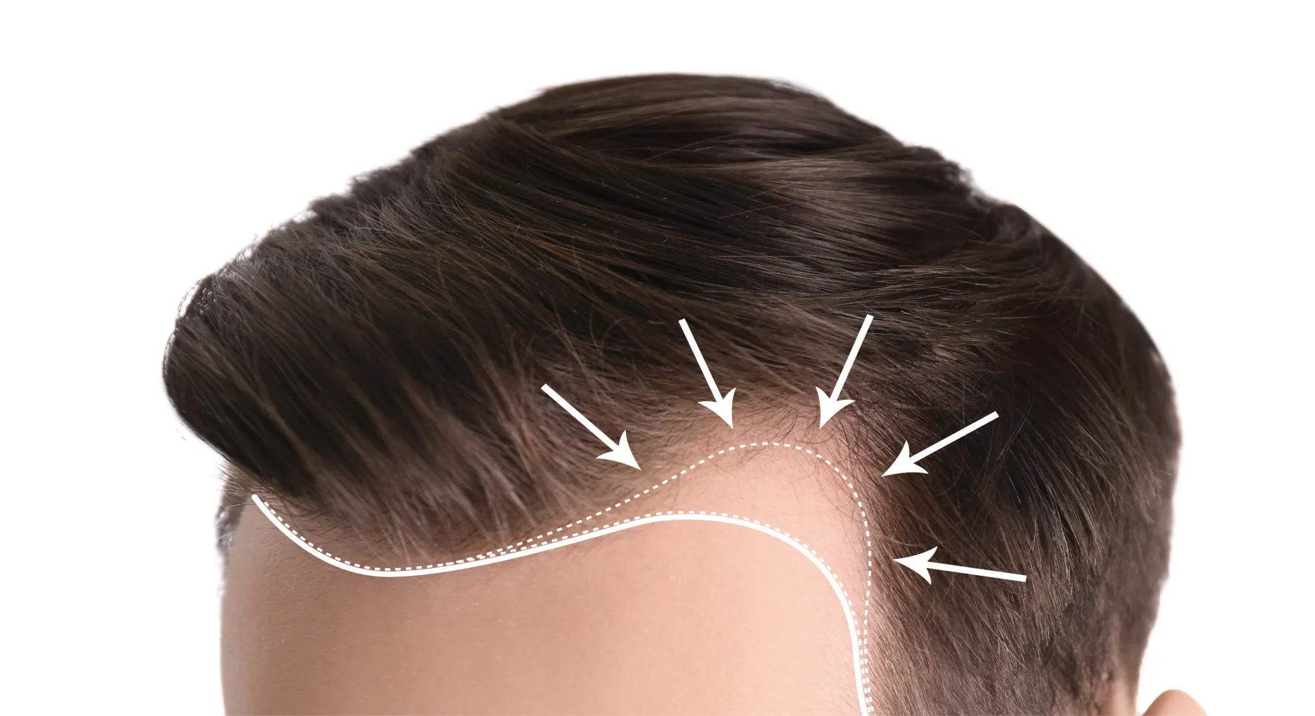 What is the ideal hairline during hair transplantation?